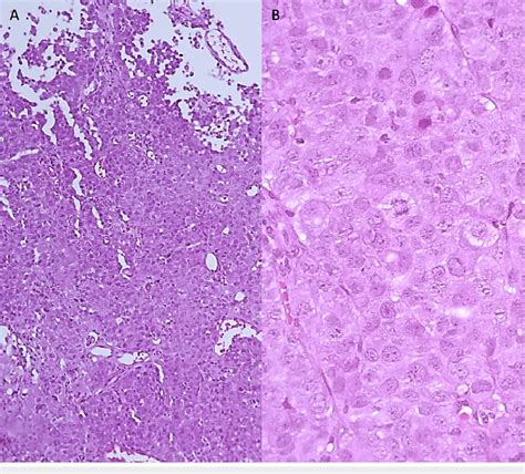 Hematoxylin And Eosin Stain A Sheets Of Cells Large Cells With Big
