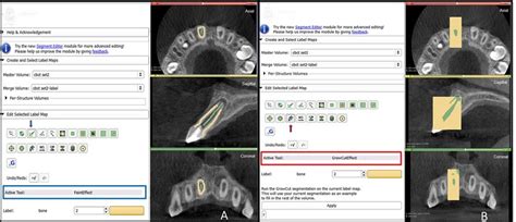 Grow Cut Technique In 3d Slicer A Initialization Of An Area Inside