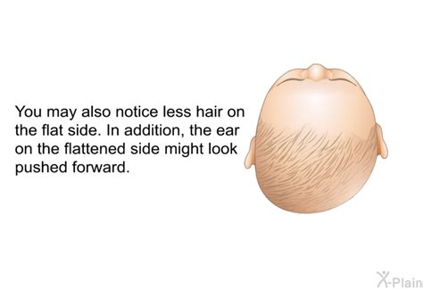 Positional Plagiocephaly