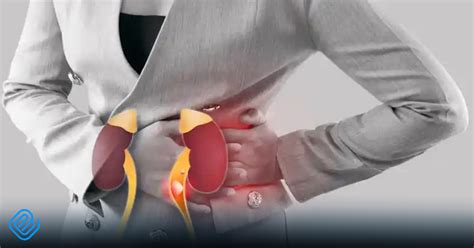 فعالية اقراص نو يوريك في علاج حصوات الكلى الناتجة عن حمض اليوريك الطبى