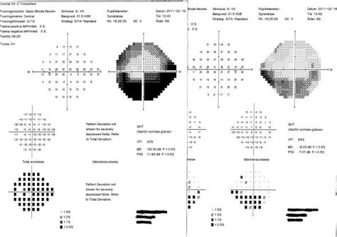 An Hvf Test From One Of The Subjects Included Missed Test Points Can