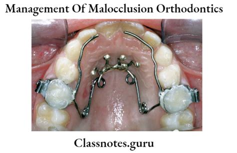 Management Of Malocclusion Orthodontics Question And Answers Class Notes