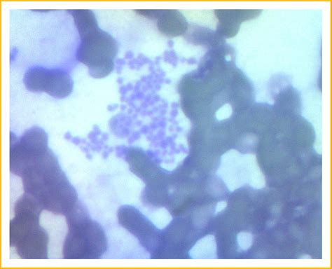 Concurrent Pseudothrombocytopenia And Immune Thrombocytopenia The