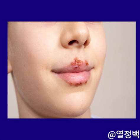 입 주변 수포 입 주위 구순포진 원인 증상 치료 기본정보 네이버 블로그