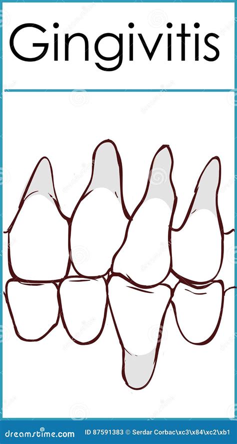 Gingivitis Inflammation Of The Gums Dental Calculus Infographics Vector Illustration On