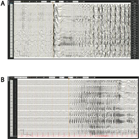 SEEG Recordings Showing Example Ictal Onsets A Ictal Onset Showing