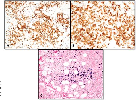 Hydroa Vacciniforme Like Lymphoma Semantic Scholar