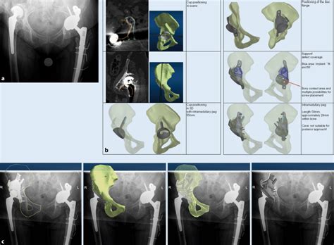 Acetabular Defect Classification In Times Of 3d Imaging And Patient Specific Treatment Protocols