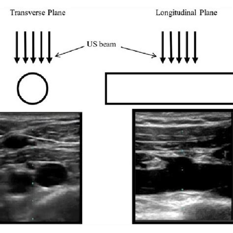 Picc Tip Termination Using 3cg Ecg Technology Download Scientific