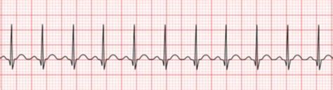 Ekg Flashcards Quizlet