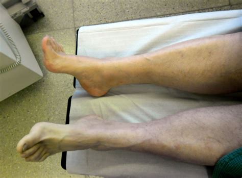 Embolism Of Left Leg Doccheck