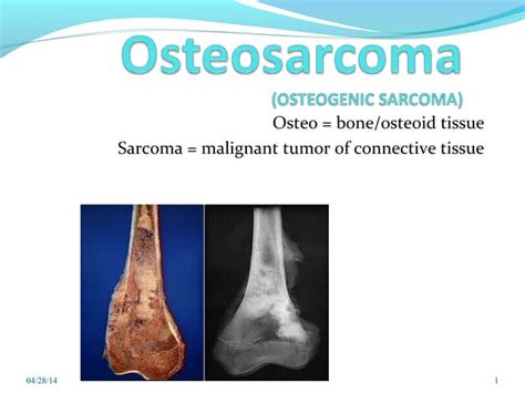Osteosarcoma Ppt Ppt