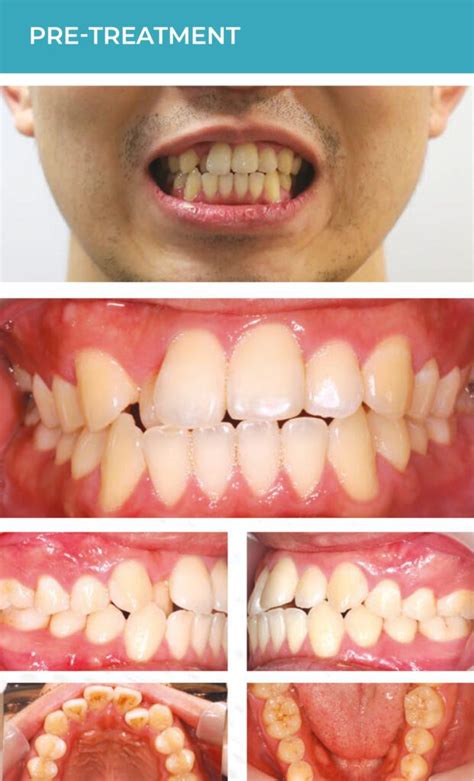 Open Bitecrowdingmidline Disrecepancy12 Crossbite Trioclear™