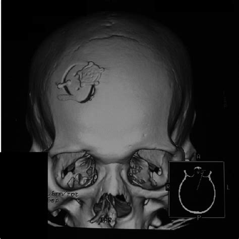 Frontal Mini Craniotomy For The Evacuation Of Spontaneous Right