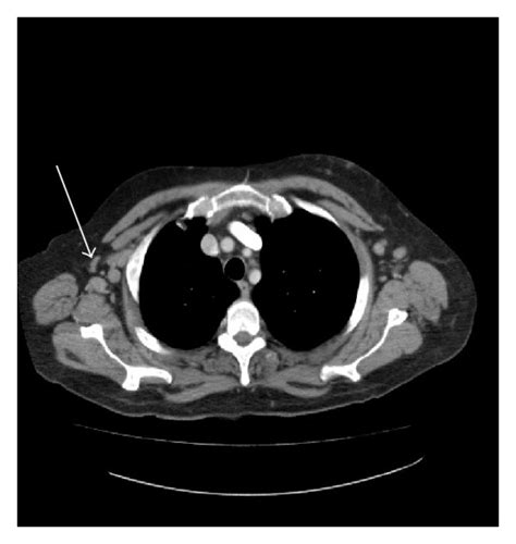 A Illustrated Ct Of The Abdomen With Pretreatment Lymphadenopathy