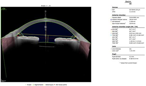 Intraocular Lens Position And Anterior Chamber Parameters Opth