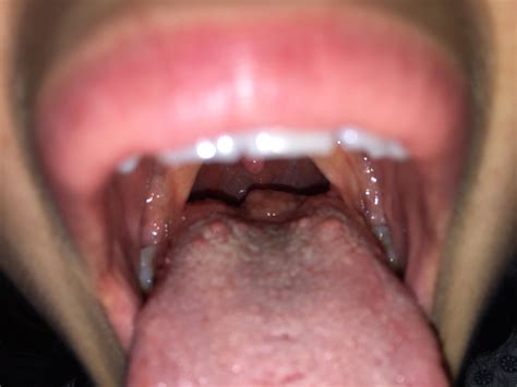Lingual Tonsil Model