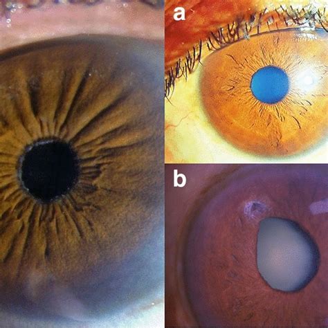 A B Whorling Iris Atrophy With Sphincteric Atrophy C 360 Degree Download Scientific Diagram
