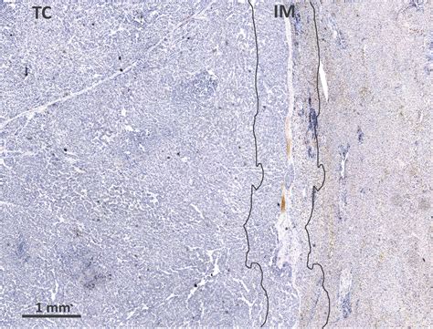 Immunoperoxidase Staining For Cd8 Lymphocytes In Hcc Regions Of