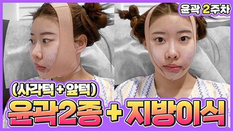 사각턱앞턱지방이식 수술 2주차 🥴 윤곽수술 저는 조금 아프던데요 Youtube