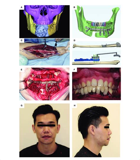 A Case Illustration Of A 32 Year Old Male Diagnosed With Ossifying Download Scientific