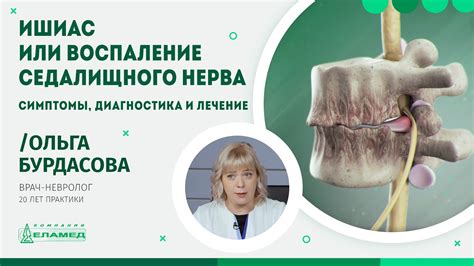 Защемление седалищного нерва: симптомы и лечение медикаментозное ...