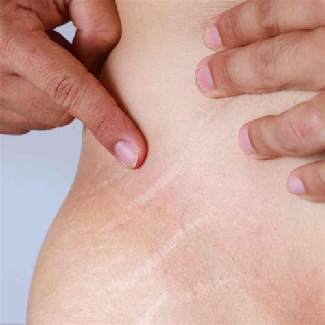 Does Laser Stretch Mark Removal Work The Pros And Cons