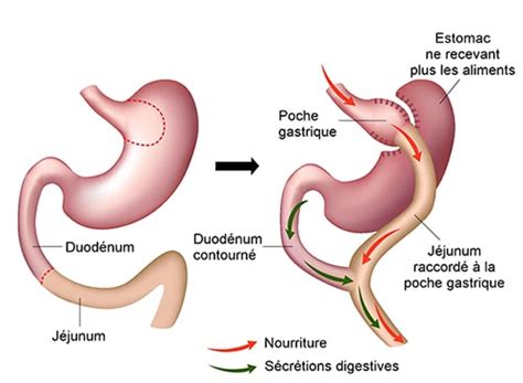 Bypass Gastrique Chirurgie Obésité Aix Près De Salon De Provence