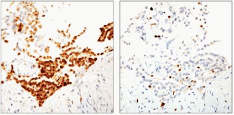 Mesothelial Hyperplasia Basicmedical Key