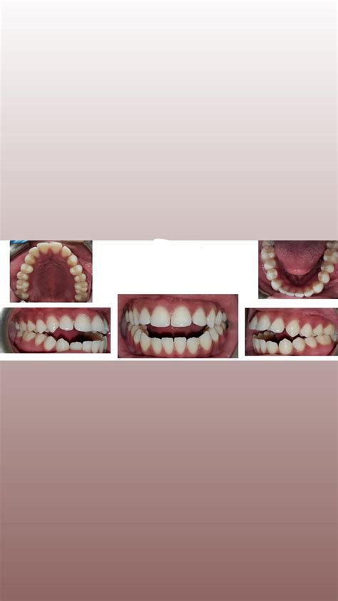 Orthodontist Wants To Extract 10 Teeth Class 3 Open Bite Malocclusion I Have 34 Teeth R
