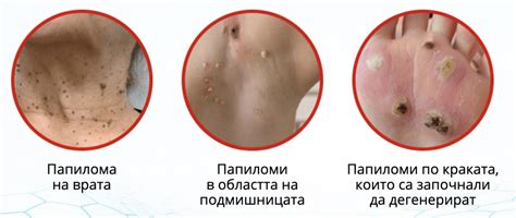 Гел писалка за брадавици и бенки Moles Remover Yves