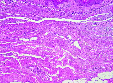 Medium Power Photomicrograph Of The Skin Biopsy Showing Dermal Download Scientific Diagram