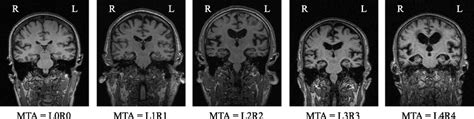 Visual Example Of Medial Temporal Atrophymta In Different Stages Of Download Scientific