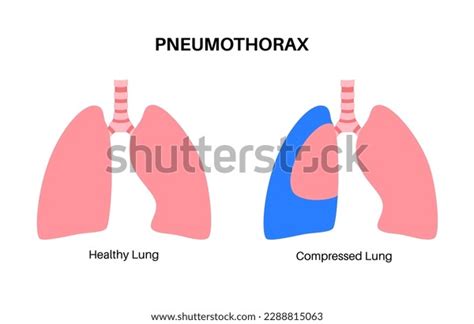 Pneumothorax Disease Flat Vector Collapsed Lung Stock Vector Royalty