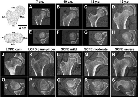 Statistical Shape Modeling Of Proximal Femoral Shape Deformities In Legg Calvé Perthes Disease