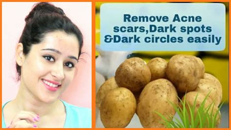 Remove Dark Spots Acne Scars Dark Circles And Pigmentation Fast In 2