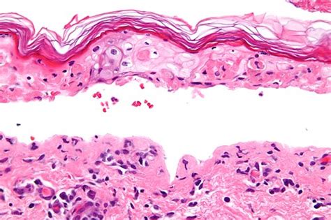 Epidermal Necrosis Libre Pathology