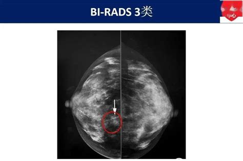 X Bi Rads