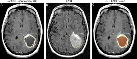 Glioblastoma Imaging Genomic Mapping Reveals Sex Specific Oncogenic