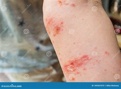 Poison Ivy Rash Arm