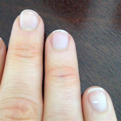 What Causes White Spots On Your Fingernails Design Ta
