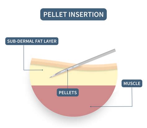 Best Pellet Therapy Miami Fl Dr Jason Shapiro