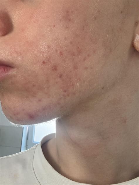 Acne Dark Spots And Acne Marks Rskincareaddiction