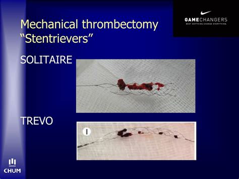 Ppt Endovascular Treatment Of Acute Ischemic Stroke Powerpoint