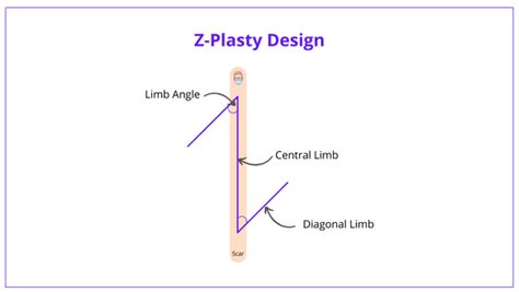 Z Plasty Designs Indications Variations And Complications