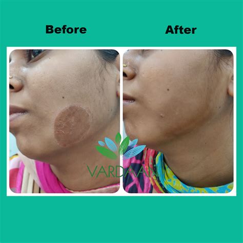 Eczema