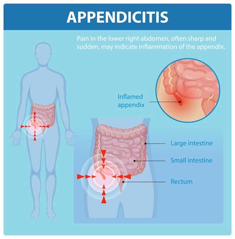 Comprendre Lappendicite Et Ses Symptômes Vecteur Gratuite