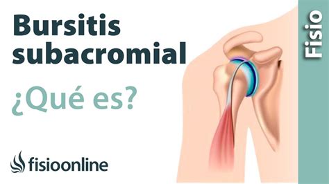 ¿qué Es La Bursitis Subacromial Youtube
