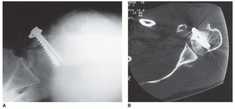Mclaughlin Procedure For Acute And Chronic Posterior Dislocations