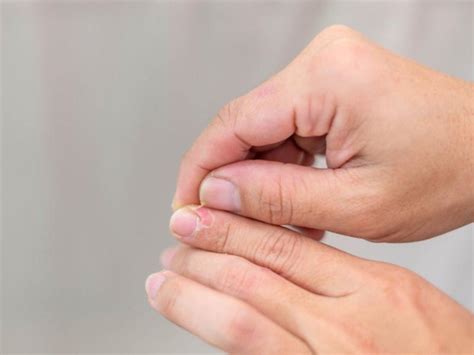 Por qué salen los padrastros en los dedos